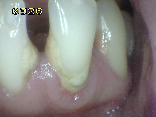 Root Caries Criteria