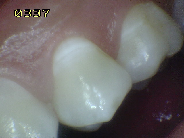 Diagnóstico diferencial entre as formas más de fluorose dental