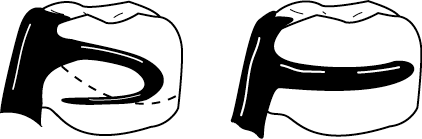 Retenedor circunferencial